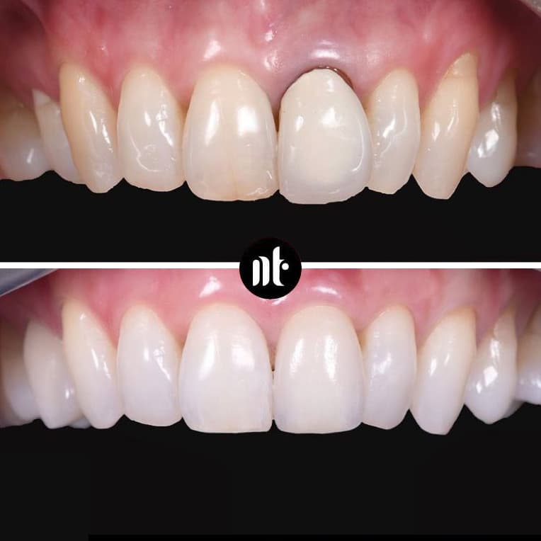 Greffe de gencive photos avant / après | Paris | Dr Temestet